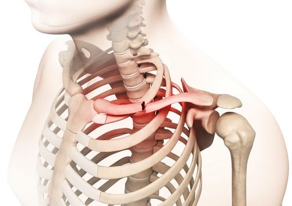 Solisluun murtuma yhä useammin leikkauspöydälle - Lääkärilehti