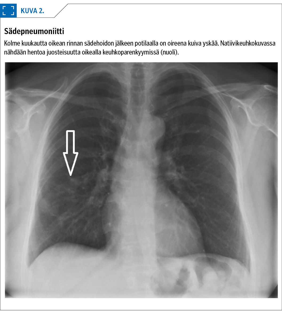Lääkärilehti - Sädehoidon haittavaikutukset