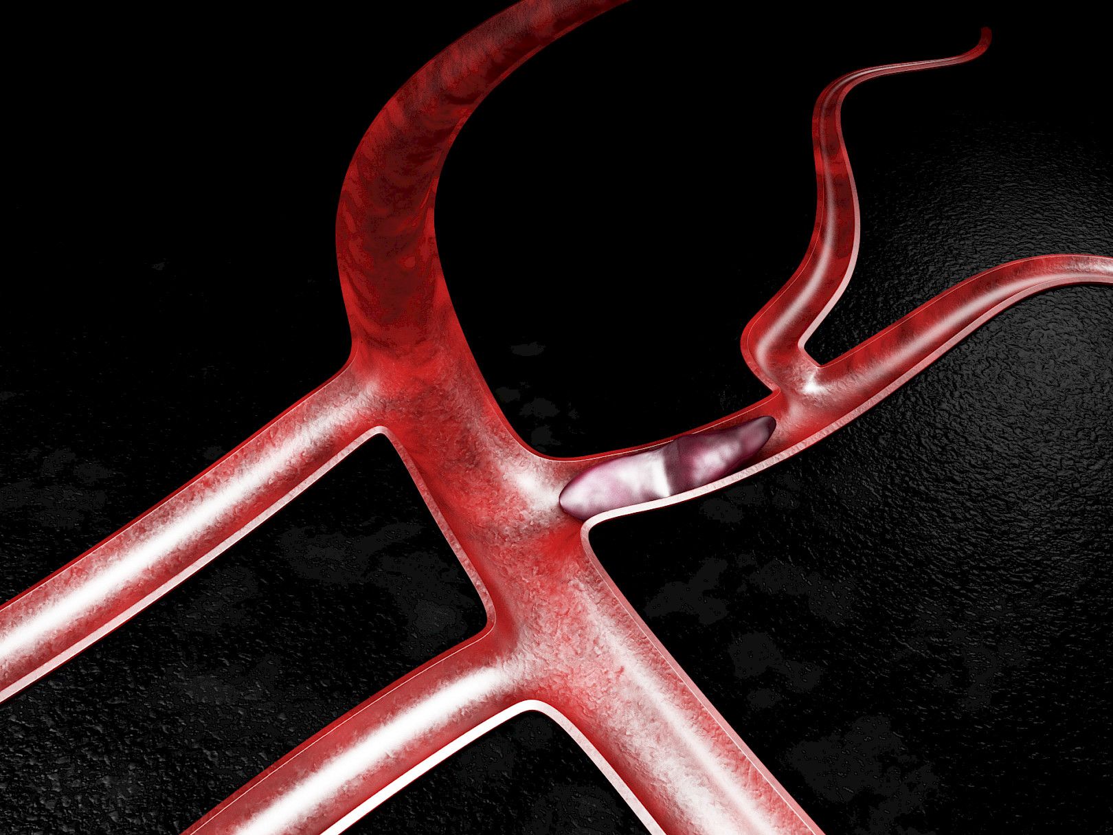 Syvä laskimotukos tai keuhkoembolia – mitä taustalta löytyy? - Lääkärilehti