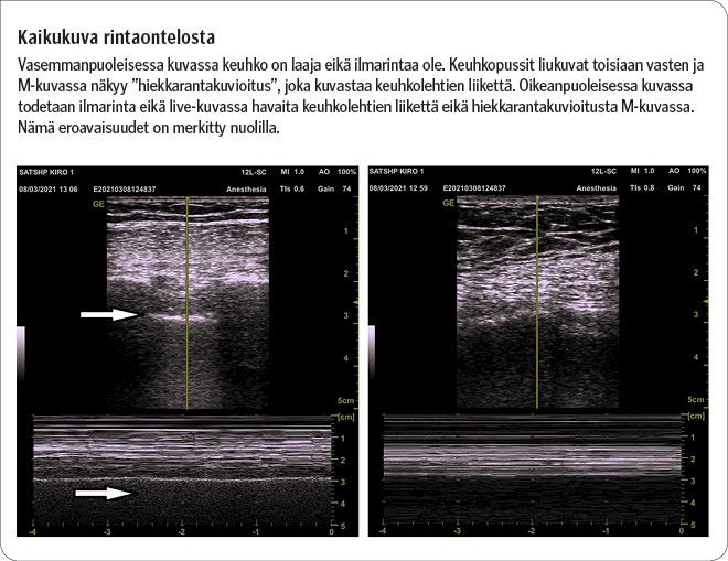Onko keuhko laaja? - Lääkärilehti
