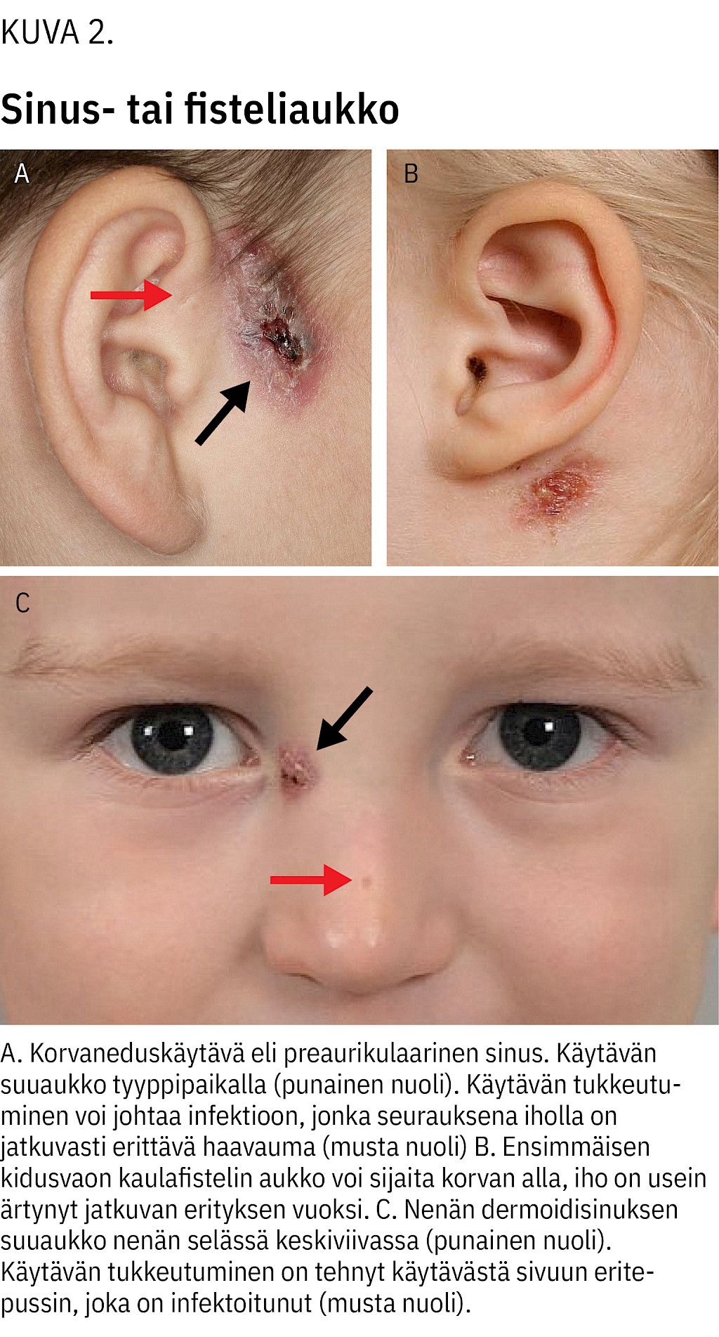Patti, reikä vai mitä kummaa? - Lääkärilehti