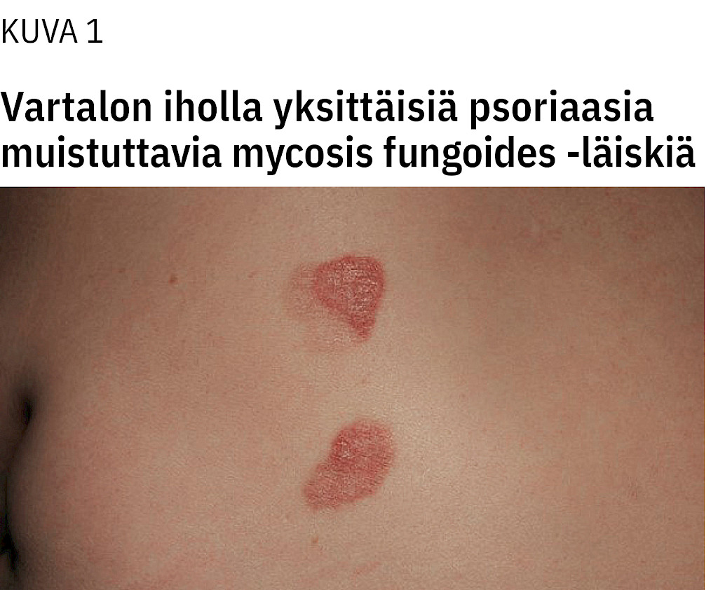 Ei mikä tahansa läiskä – ovelat ihon T-solulymfoomat - Lääkärilehti