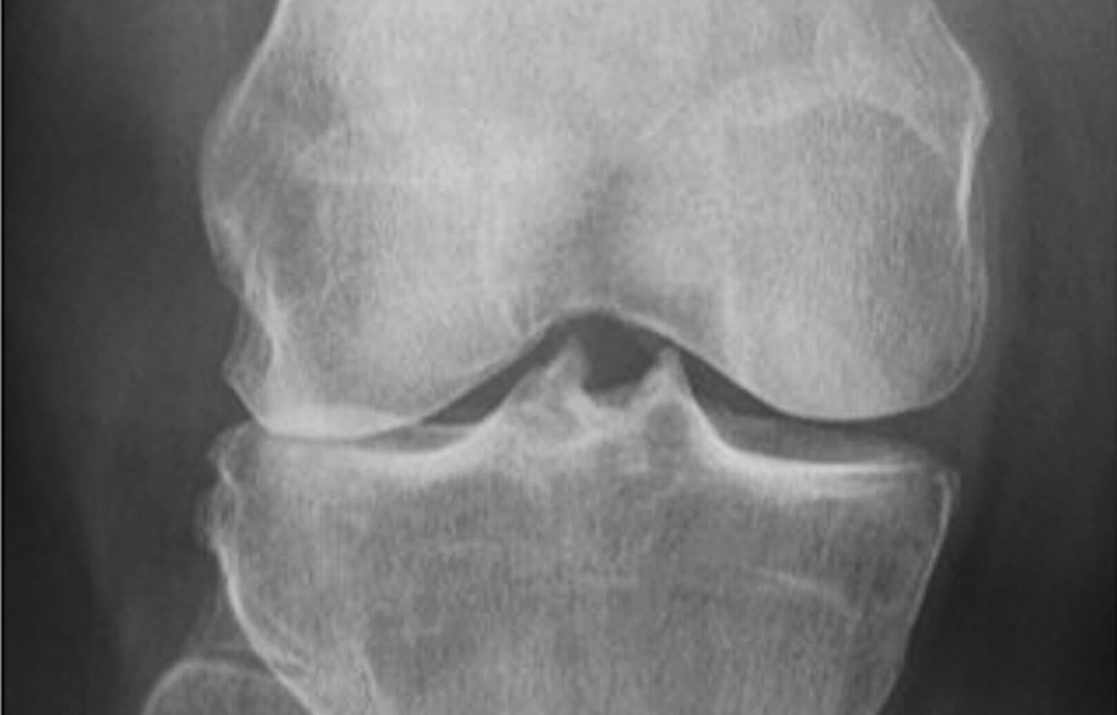 Miten polven rappeutumista diagnosoidaan? - Lääkärilehti